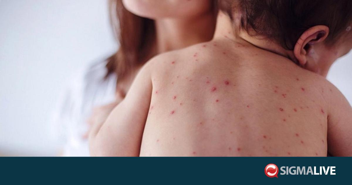 ΗΠΑ: Επιδημία ιλαράς στο Τέξας - 2 νεκροί και 120 κρούσματα - Sigmalive