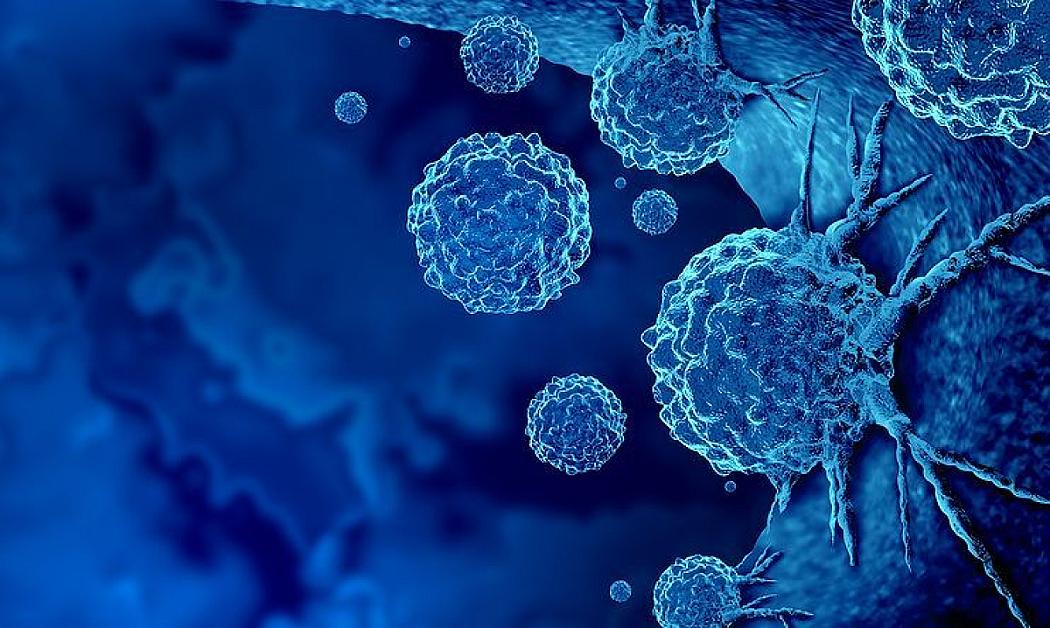 Τεράστια αύξηση στην εμφάνιση καρκίνου για άτομα κάτω των 50 ετών παγκοσμίως - Sigmalive