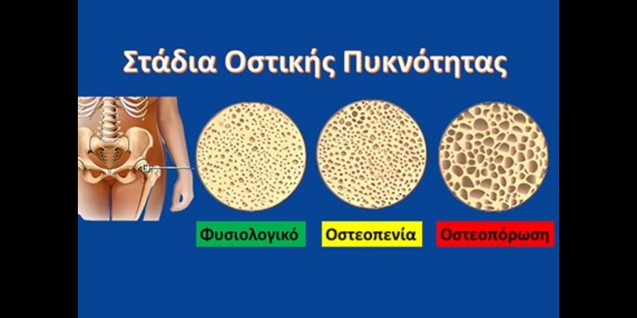 Οστεοπόρωση: Μια Σιωπηλή Απειλή για τα Οστά - Sigmalive